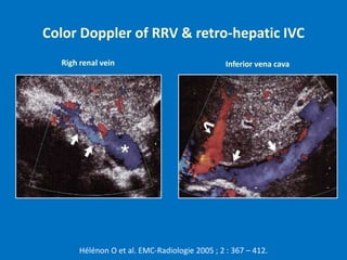 Doppler ultrasound of the kidneys 1 | PPTX