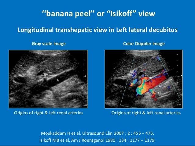 Banana Sign Ultrasound