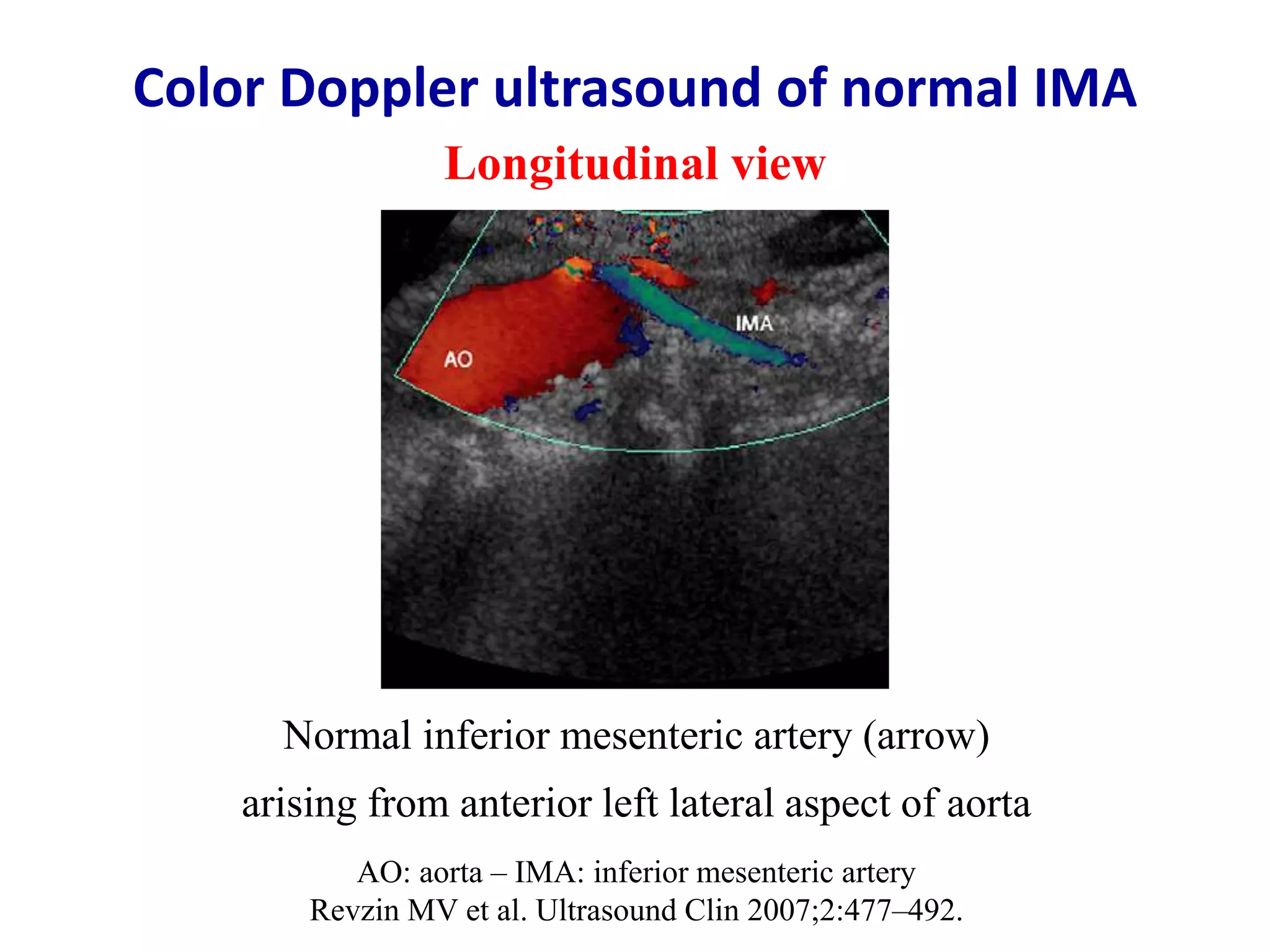 Doppler ultrasound of visceral arteries | PPTX