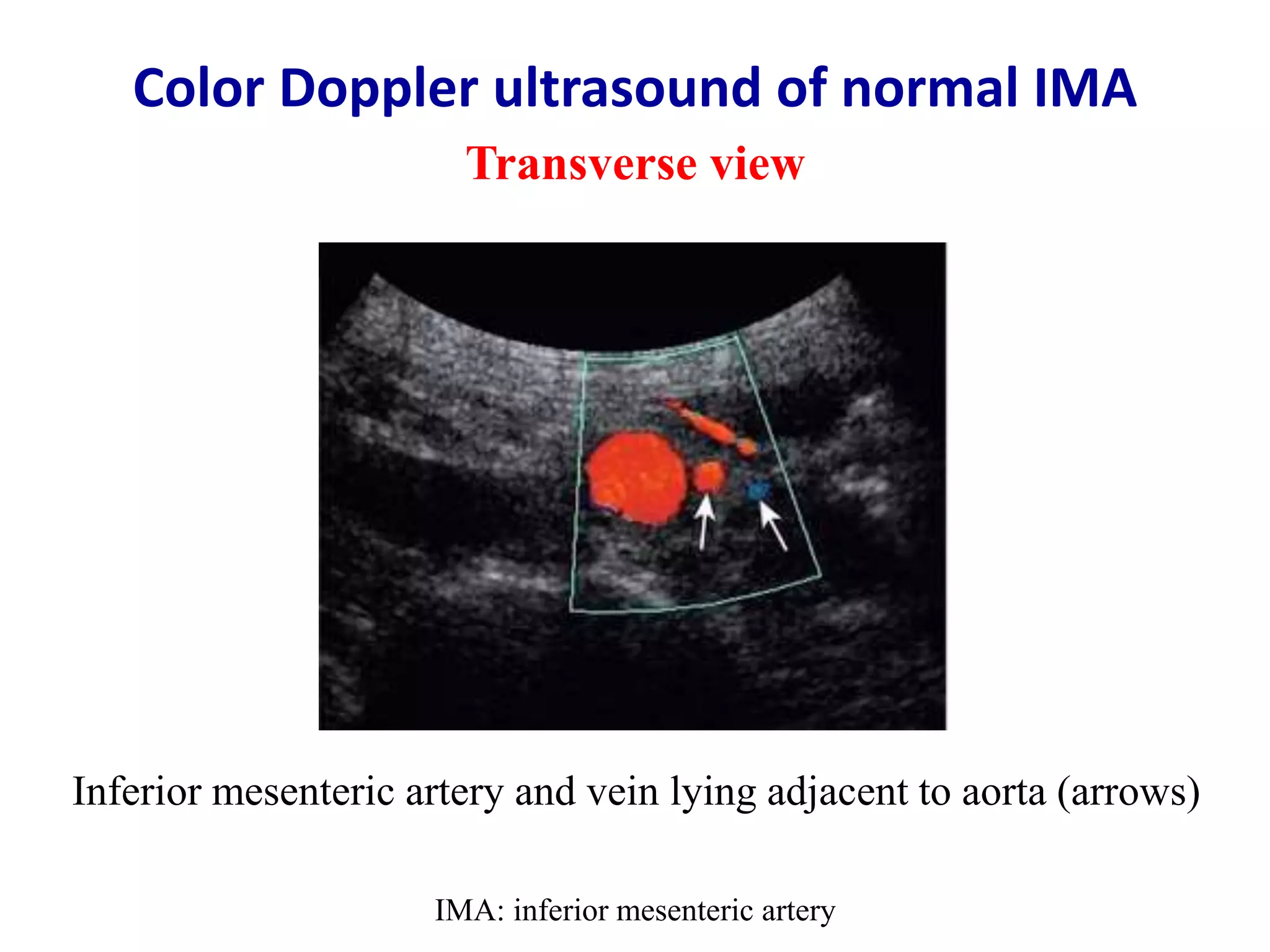 Doppler ultrasound of visceral arteries | PPTX