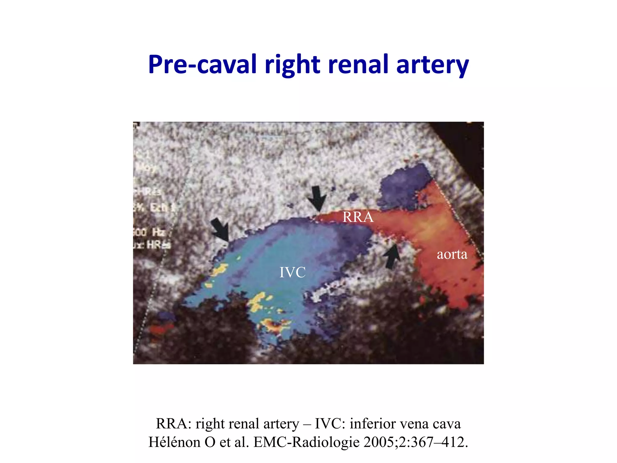 Doppler ultrasound of visceral arteries | PPTX