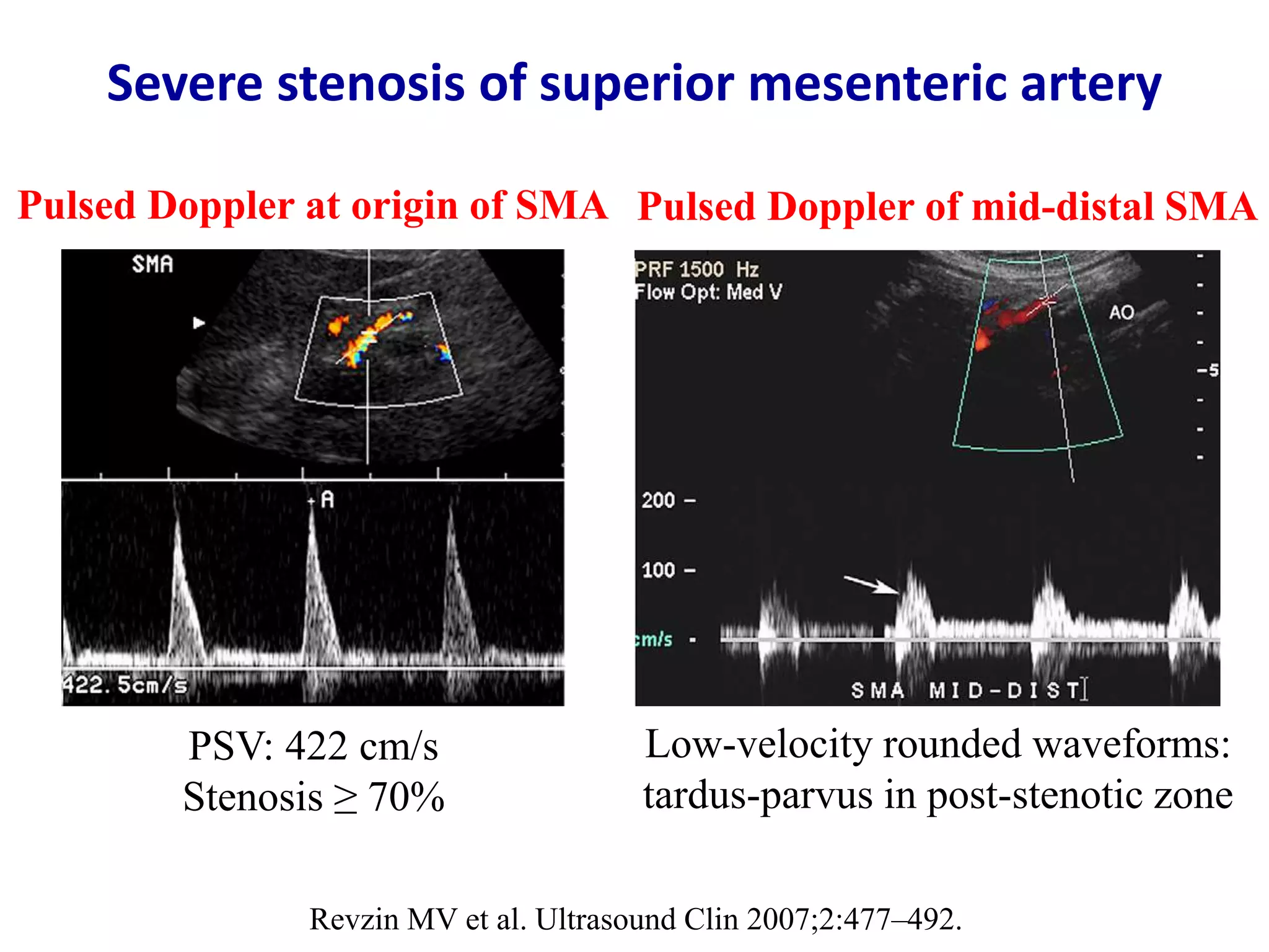 Doppler ultrasound of visceral arteries | PPTX