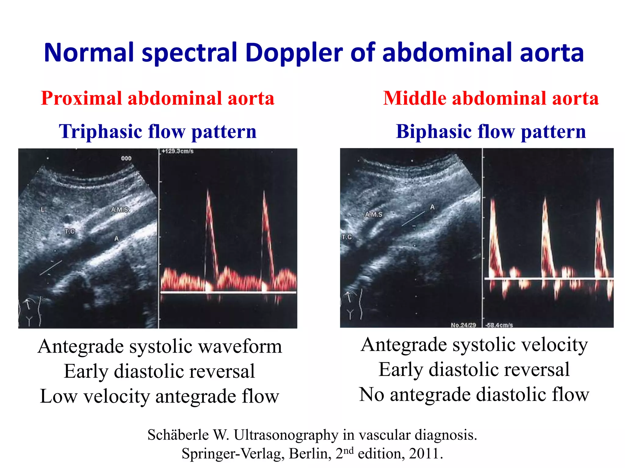 Doppler ultrasound of visceral arteries | PPTX