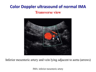 Inferior Mesenteric Artery Ultrasound