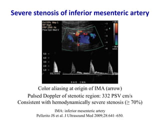 Inferior Mesenteric Artery Ultrasound