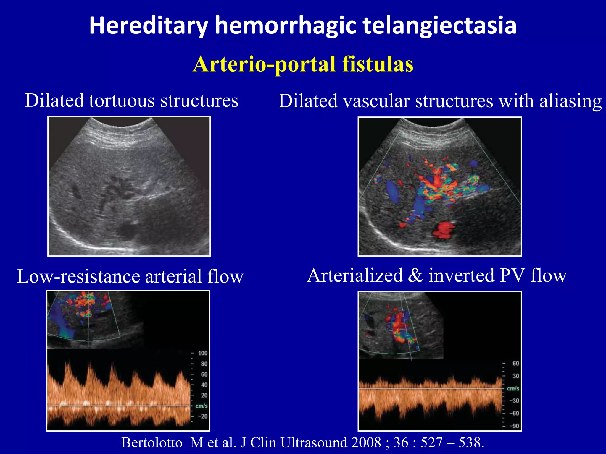 Doppler ultrasound of the liver in hereditary hemorrhagic ...