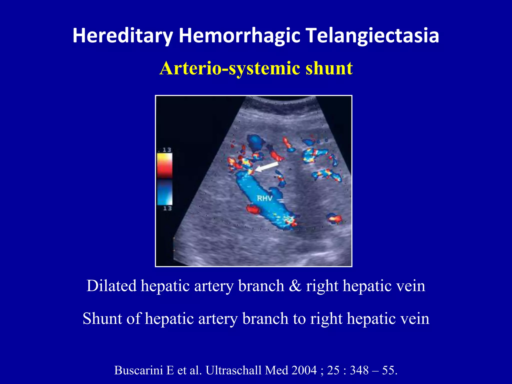 Doppler ultrasound of the liver in hereditary hemorrhagic ...