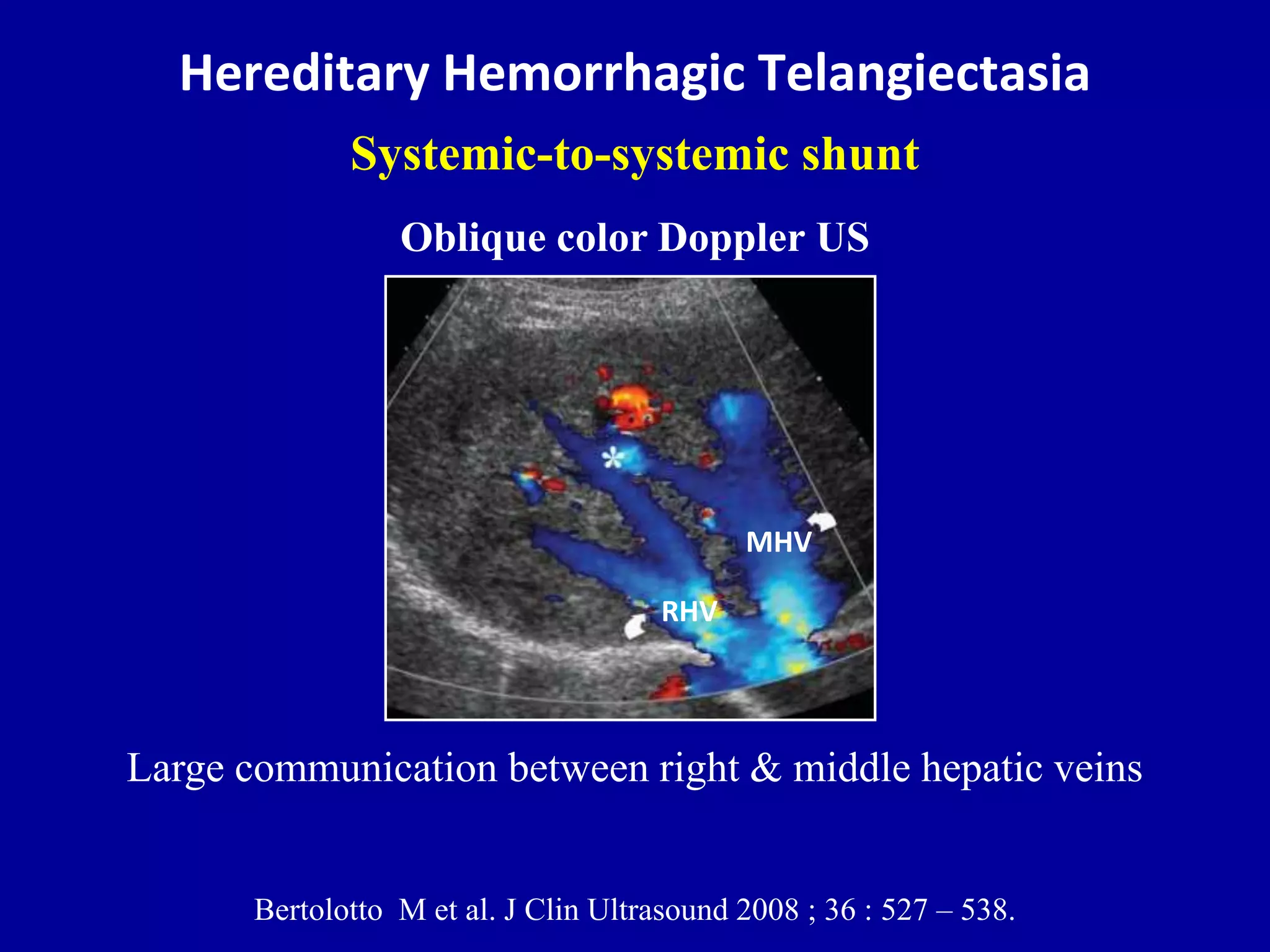 Doppler ultrasound of the liver in hereditary hemorrhagic ...