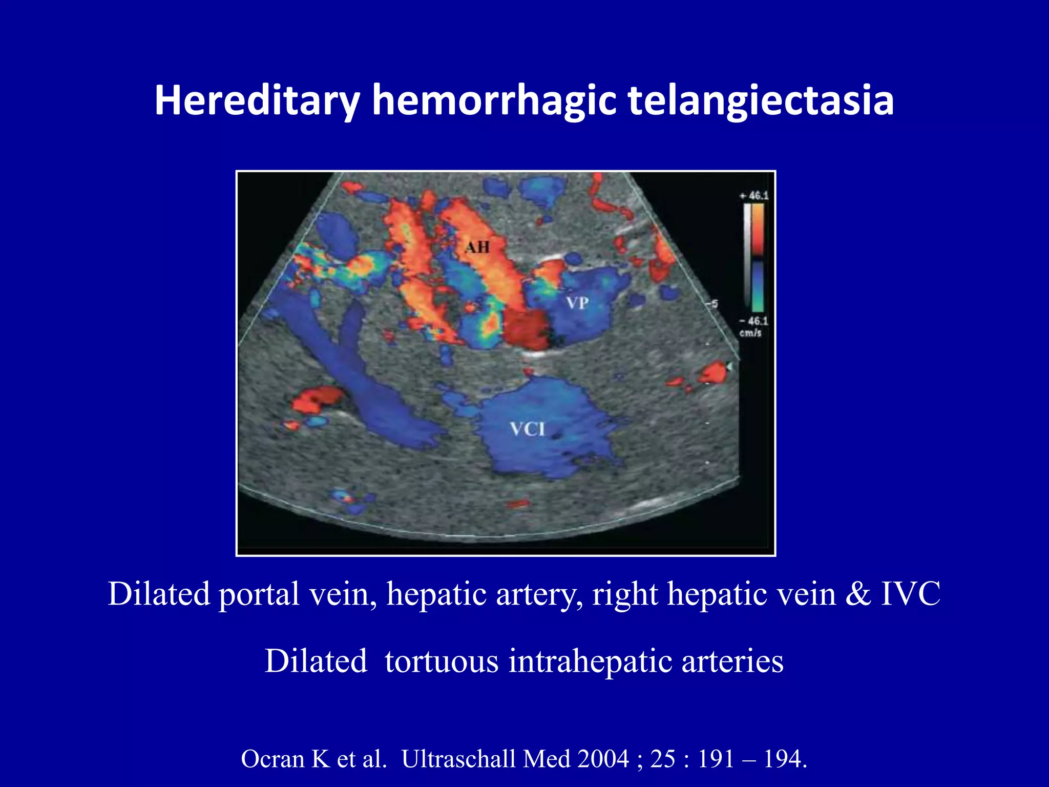 Doppler ultrasound of the liver in hereditary hemorrhagic ...