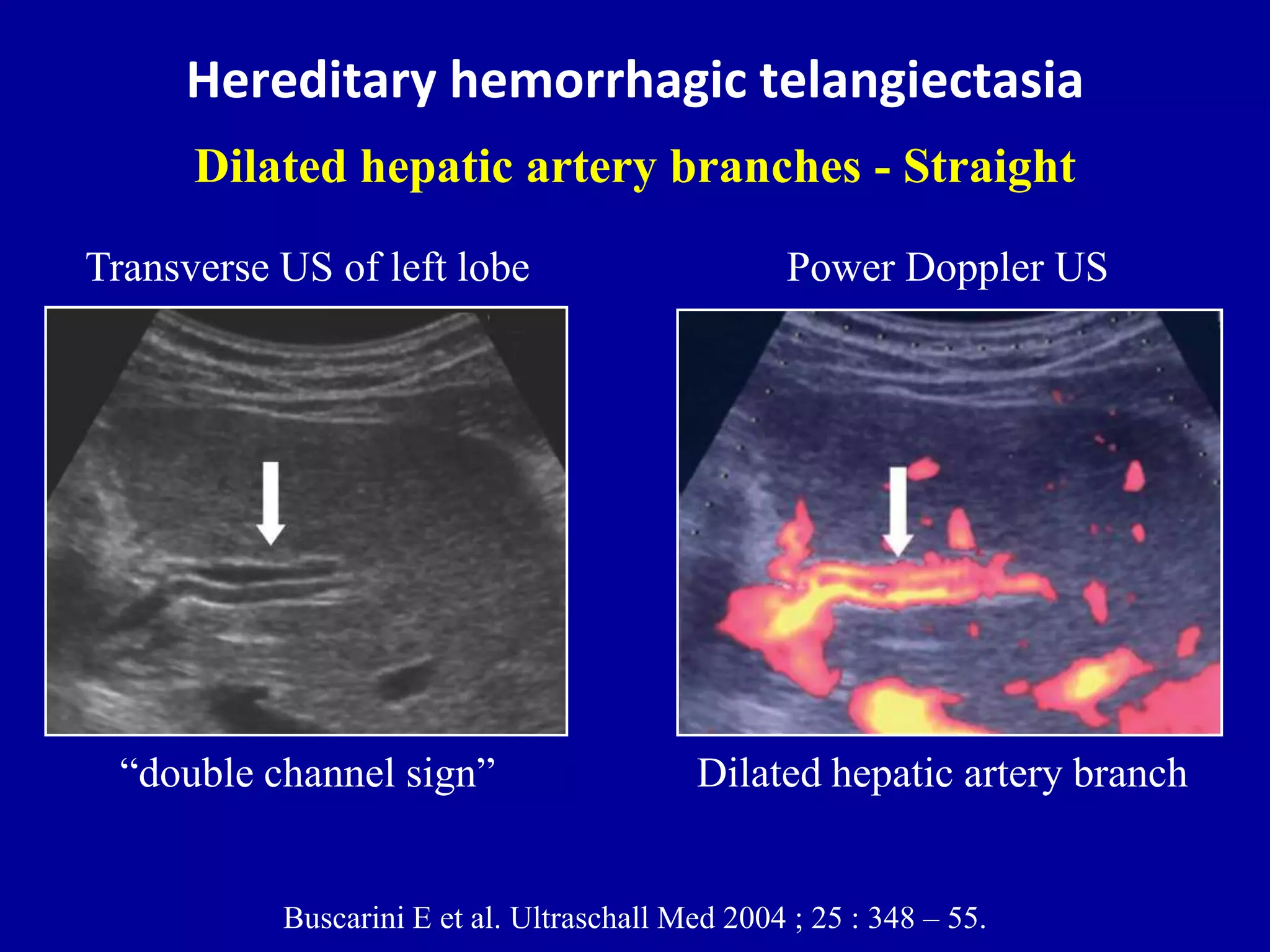Doppler ultrasound of the liver in hereditary hemorrhagic ...