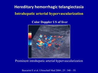Doppler ultrasound of the liver in hereditary hemorrhagic ...