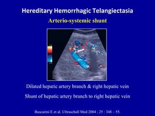 Doppler ultrasound of the liver in hereditary hemorrhagic ...