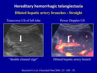 Doppler ultrasound of the liver in hereditary hemorrhagic ...
