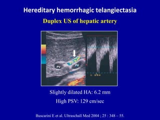 Doppler ultrasound of the liver in hereditary hemorrhagic ...