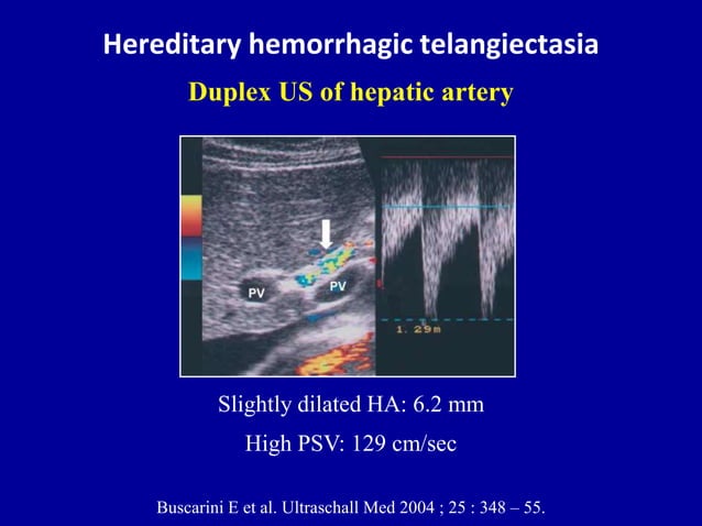 Doppler ultrasound of the liver in hereditary hemorrhagic ...