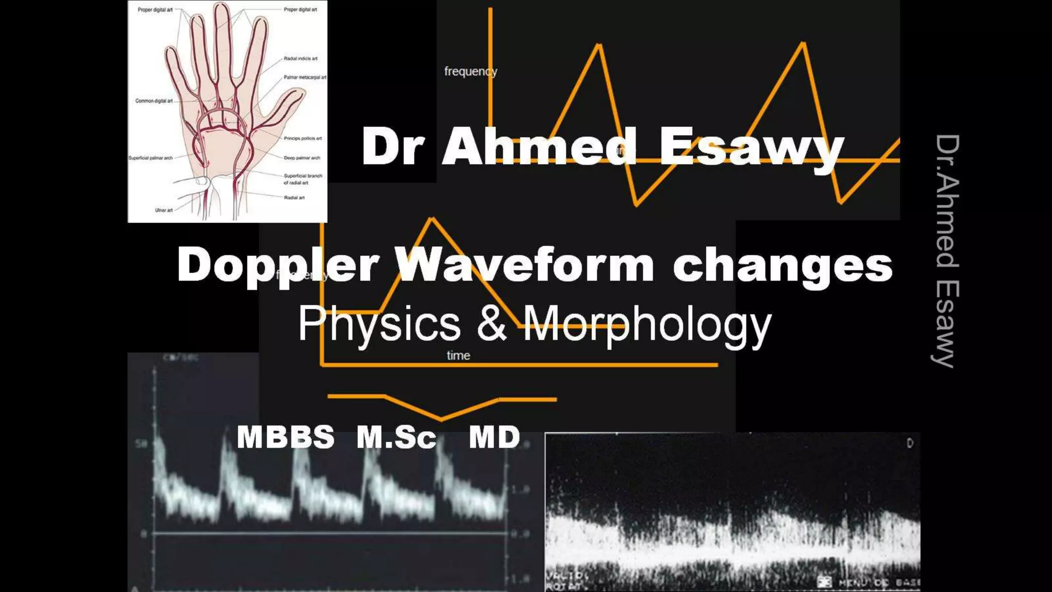 Duplex Ultrasound waveform changes | PPTX