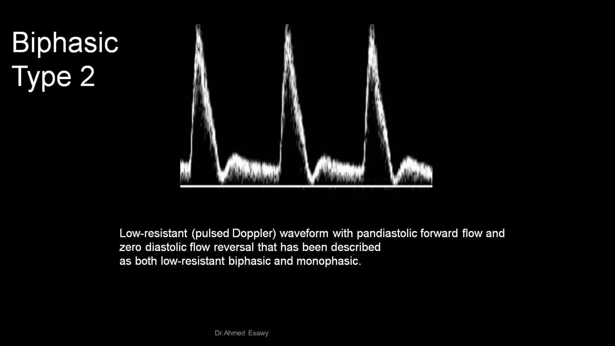 Duplex Ultrasound waveform changes | PPTX