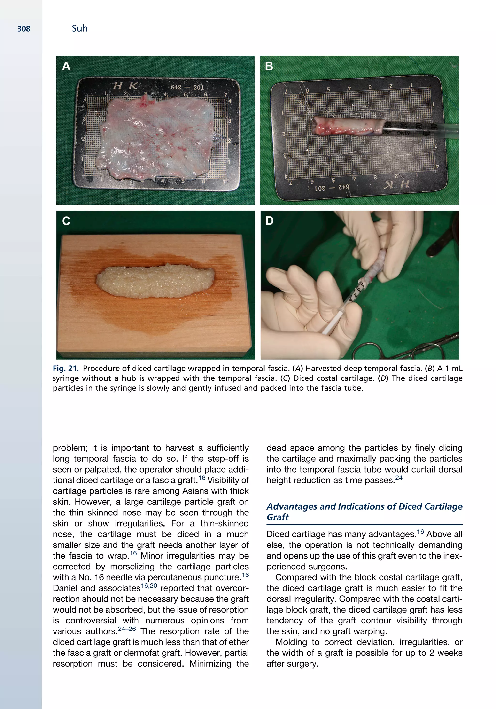 Nasal doral augmentation using autogenous tissues | PDF