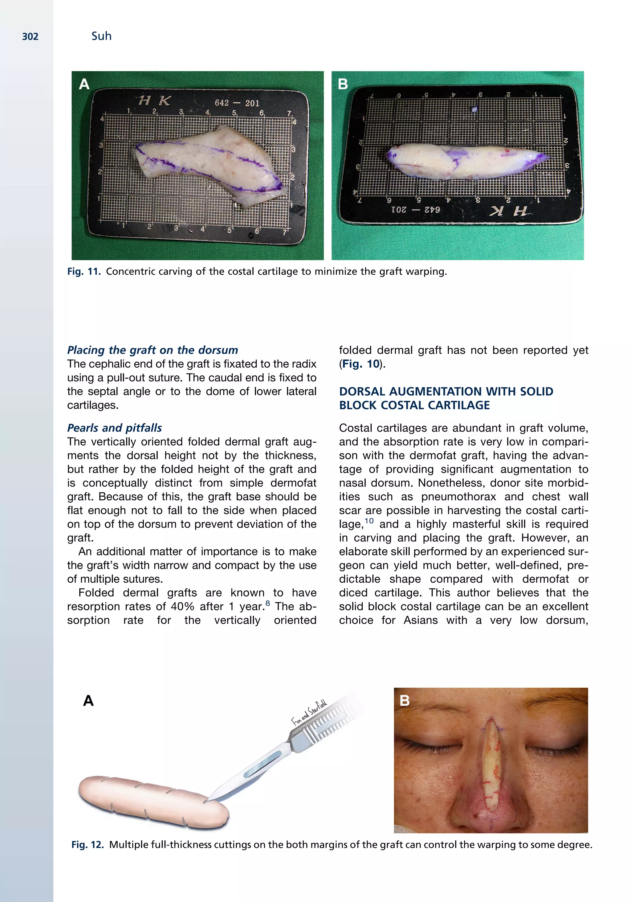 Nasal doral augmentation using autogenous tissues | PDF