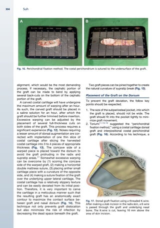 Nasal doral augmentation using autogenous tissues | PDF