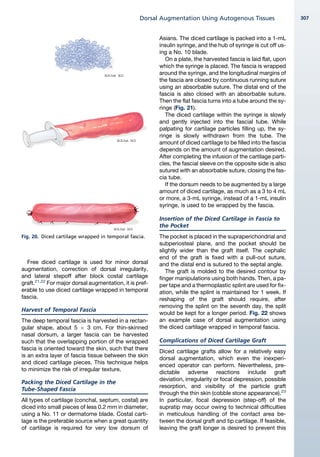Nasal doral augmentation using autogenous tissues | PDF
