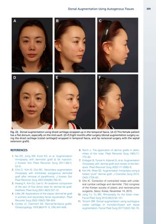 Nasal doral augmentation using autogenous tissues | PDF