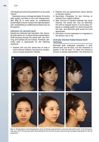 Nasal doral augmentation using autogenous tissues | PDF