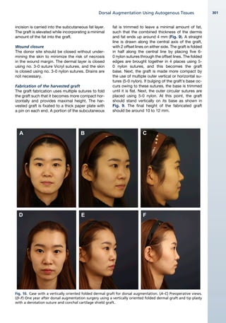 Nasal doral augmentation using autogenous tissues | PDF