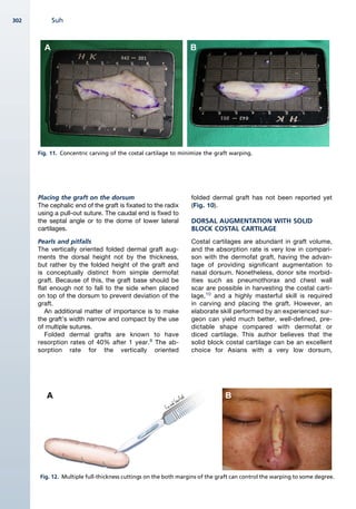 Nasal doral augmentation using autogenous tissues | PDF