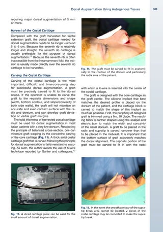 Nasal doral augmentation using autogenous tissues | PDF