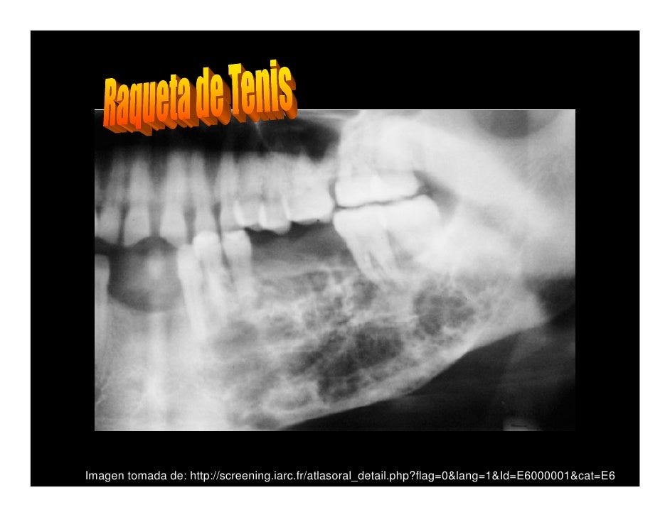 Histologia Do Mixoma Odontogenico Odontoma Pathology