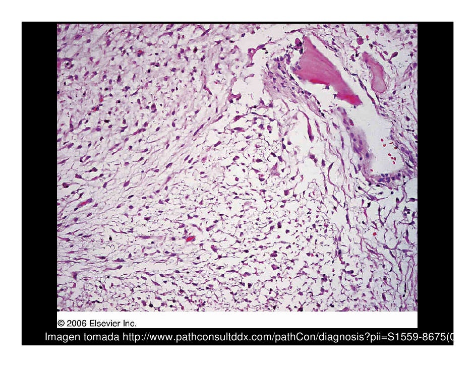 Histologia Do Mixoma Odontogenico Odontoma Pathology