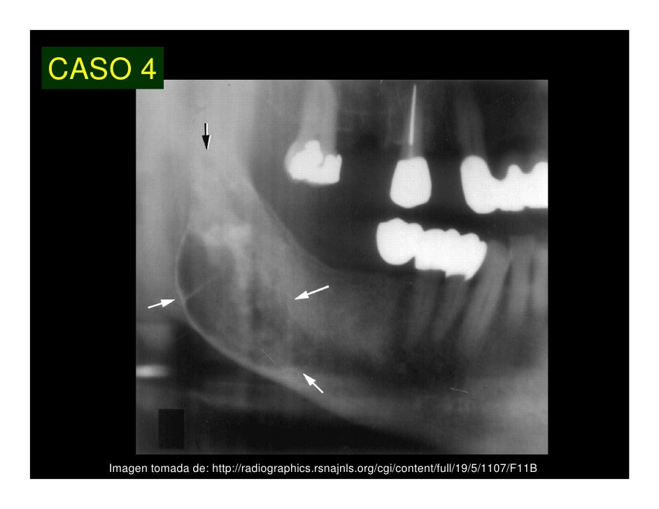 Histologia Do Mixoma Odontogenico Odontoma Pathology