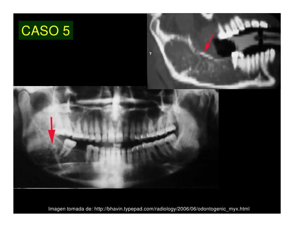 Histologia Do Mixoma Odontogenico