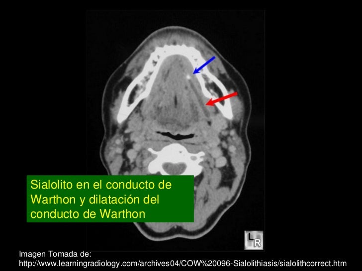 SIALOLITIASIS