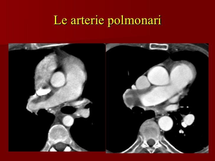 Ipertensione Polmonare : imaging radiologico