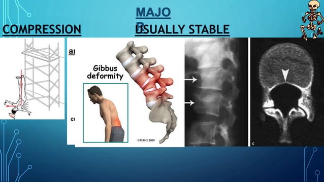 Dorsal & lumbar fractures | PPTX