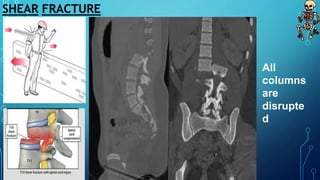 Dorsal & lumbar fractures | PPT