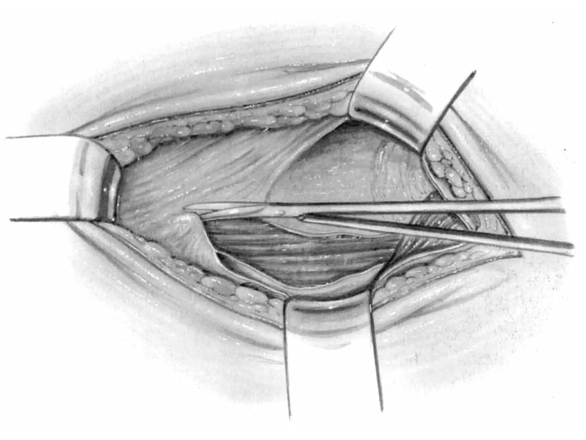 Dorsal Lumbotomy | PPT