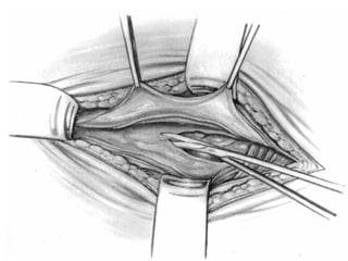 Dorsal Lumbotomy | PPT