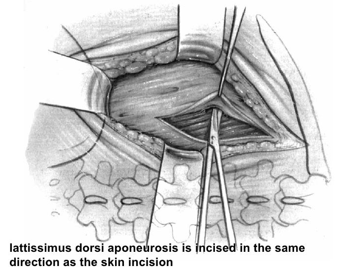 Dorsal Lumbotomy