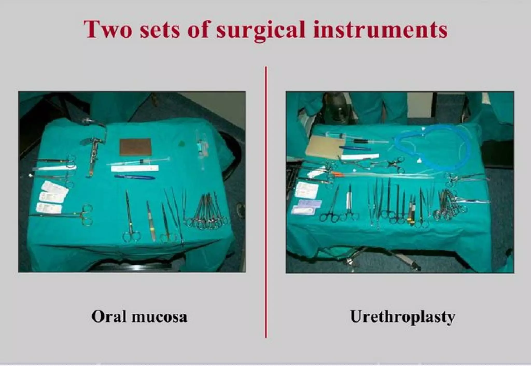 Dorsal oral mucosal onlay graft urethroplasty | PDF