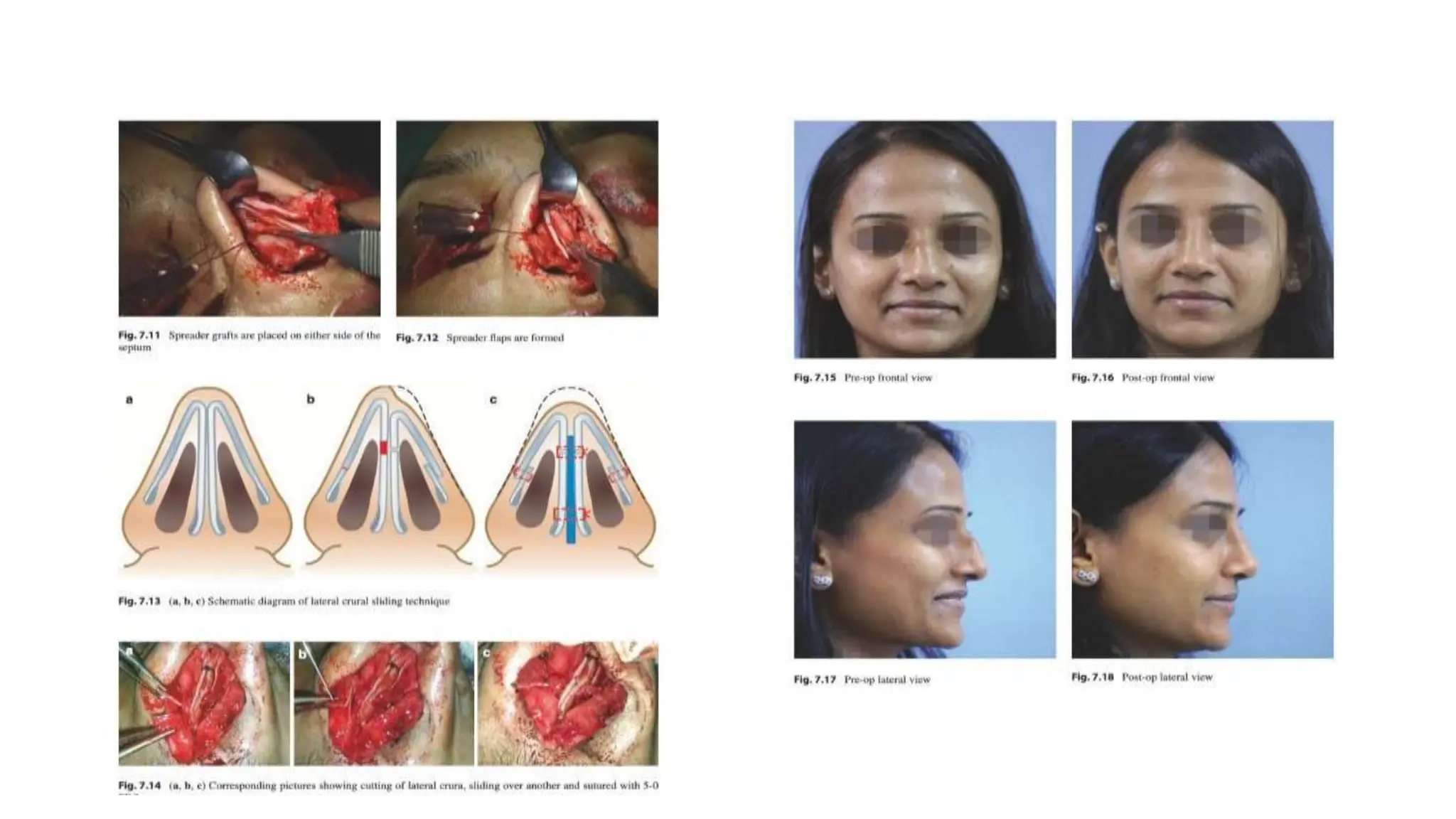 Dorsal reduction rhinoplasty by snehlata.pptx