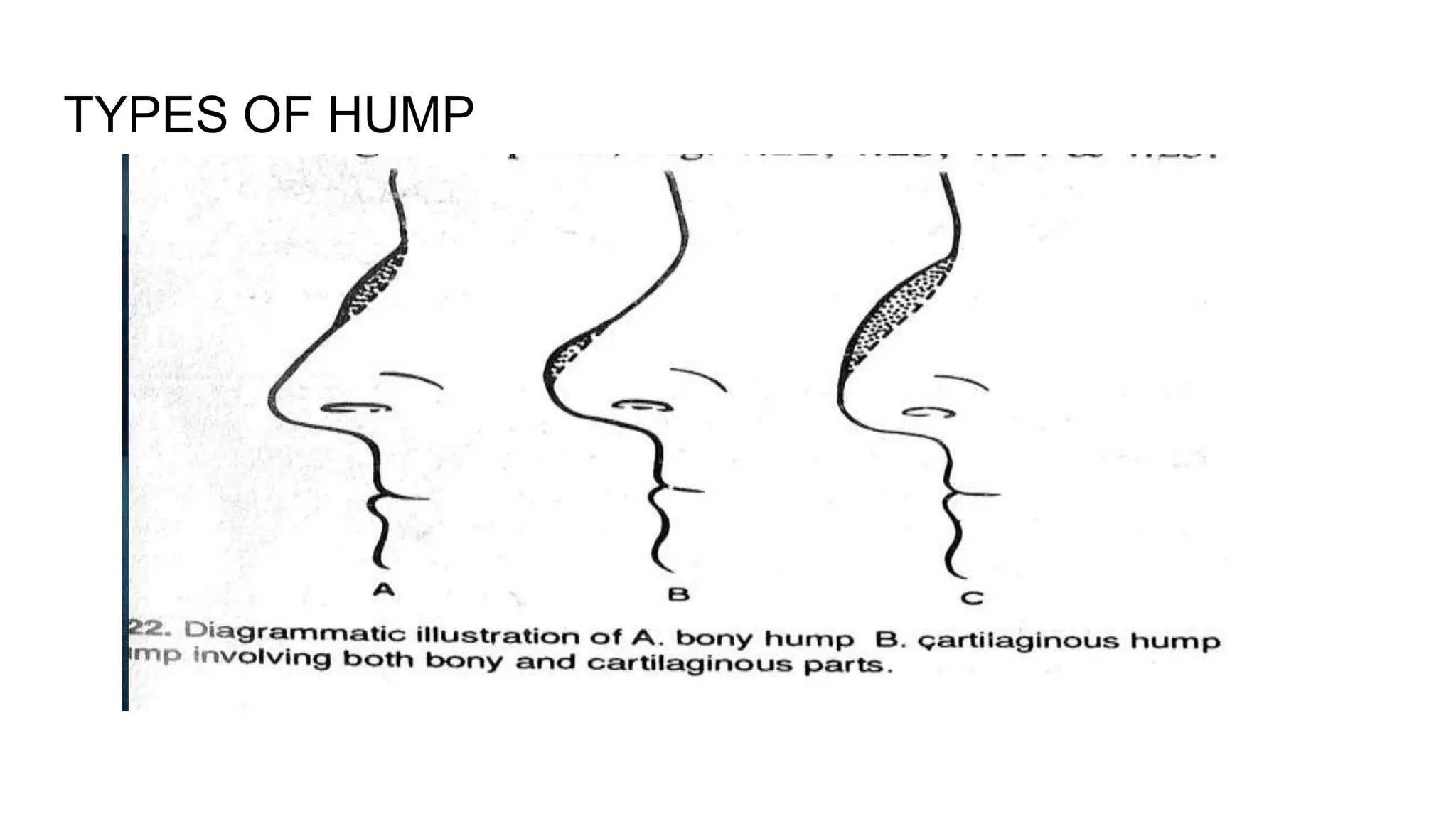 Dorsal reduction rhinoplasty by snehlata.pptx