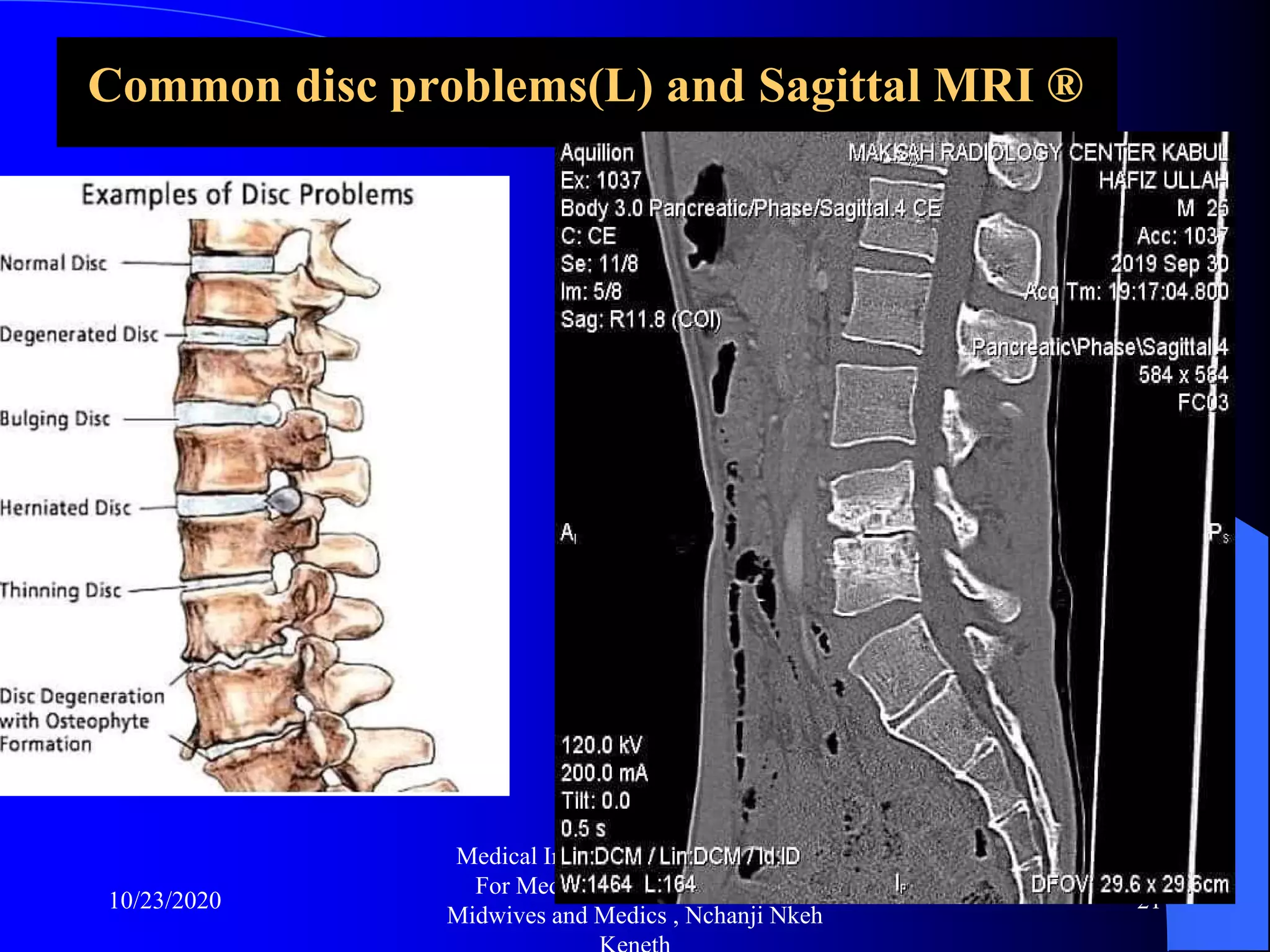Dorso lumbar spine x-ray radiology training resource nchanji nkeh ...