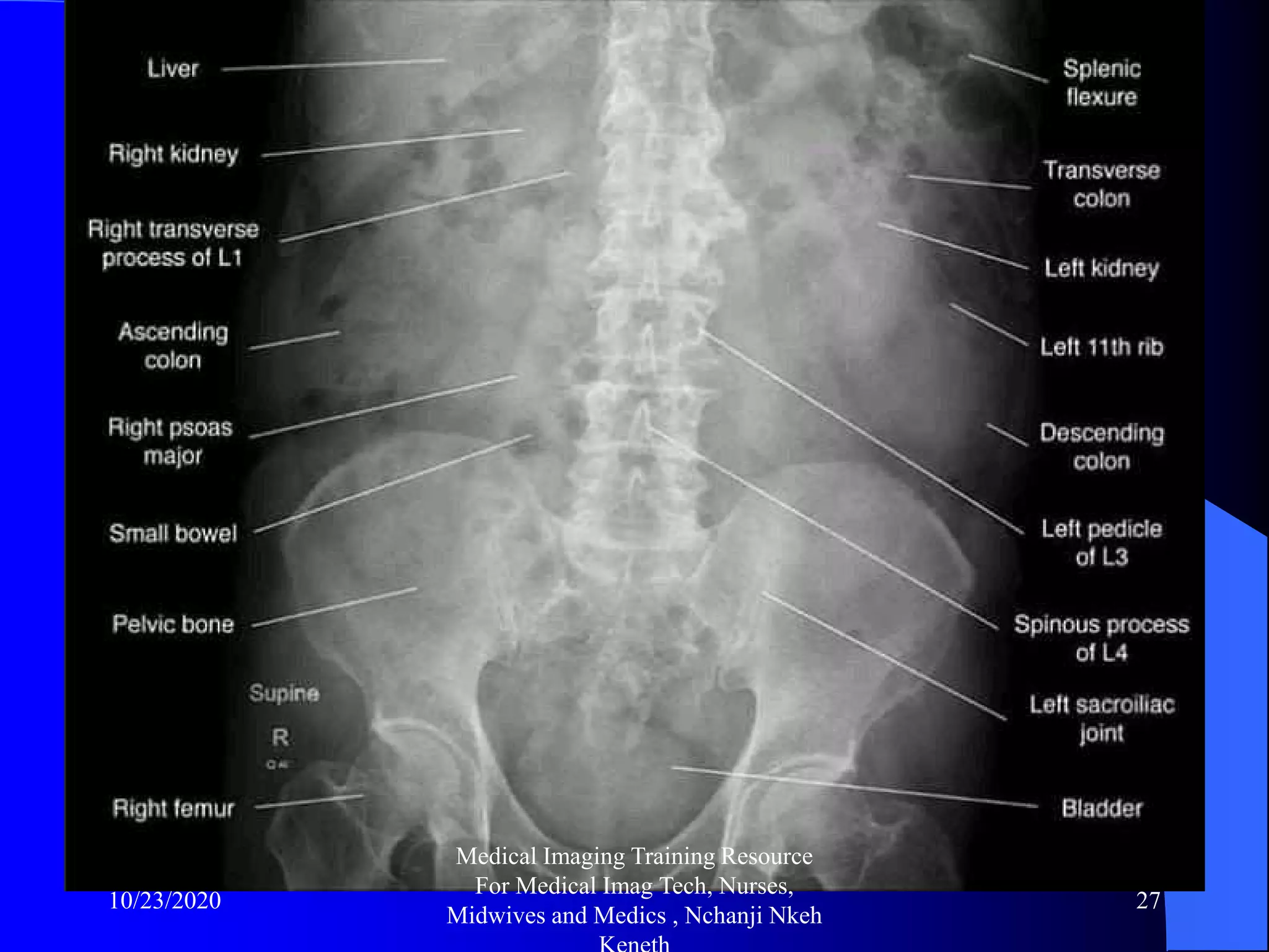 Dorso lumbar spine x-ray radiology training resource nchanji nkeh ...