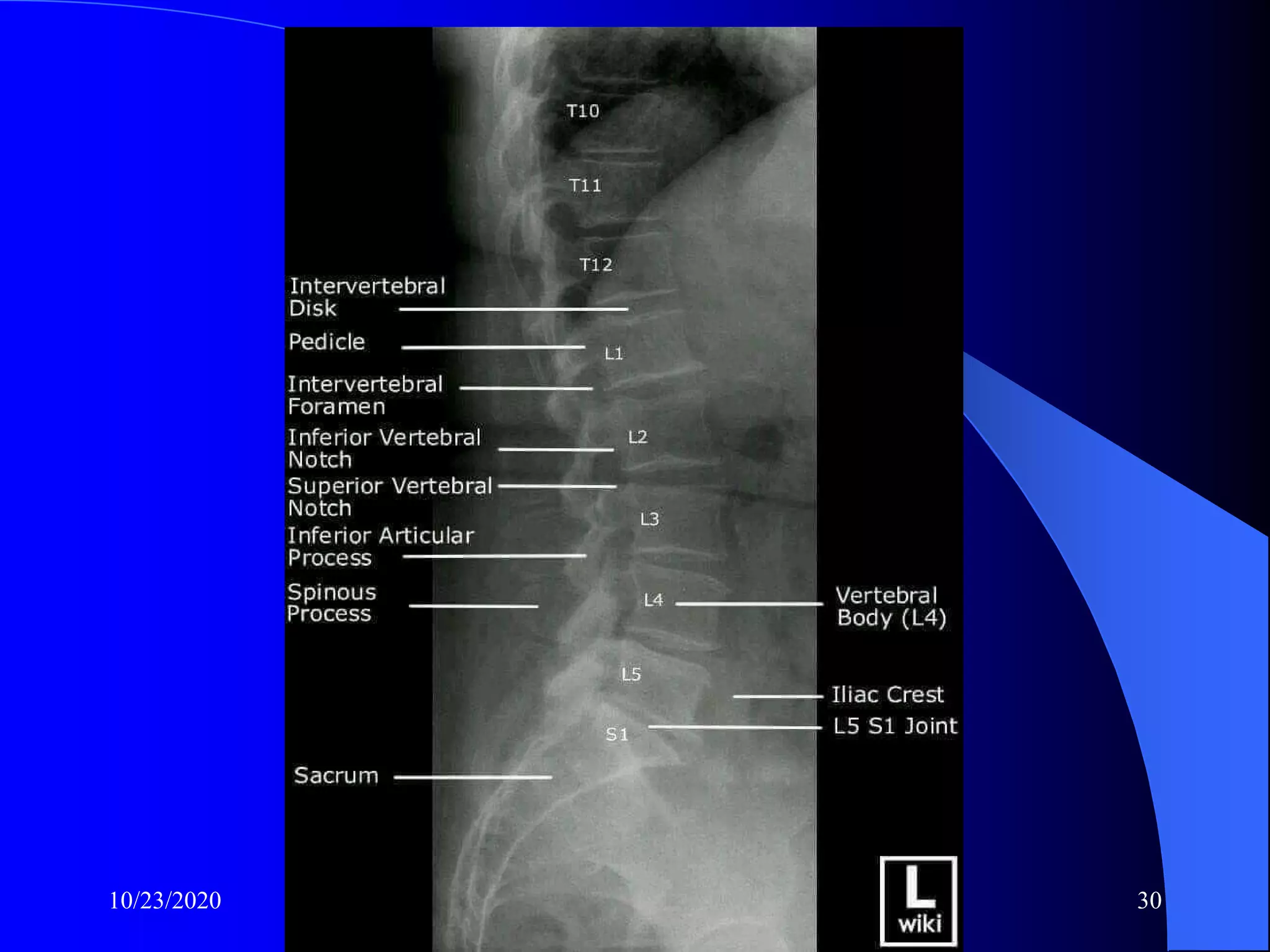 Dorso lumbar spine x-ray radiology training resource nchanji nkeh ...