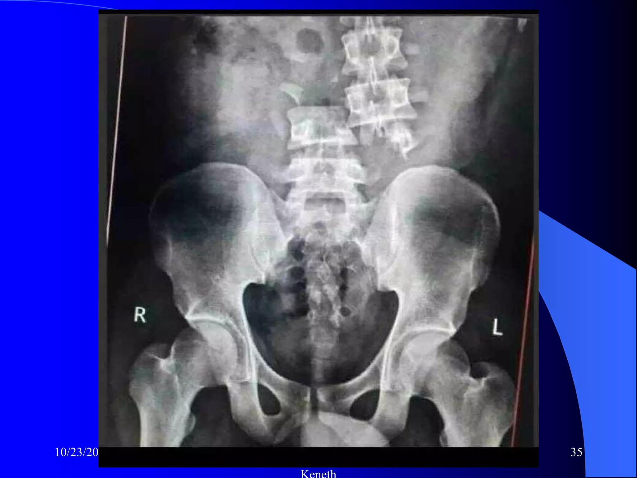 Dorso lumbar spine x-ray radiology training resource nchanji nkeh ...