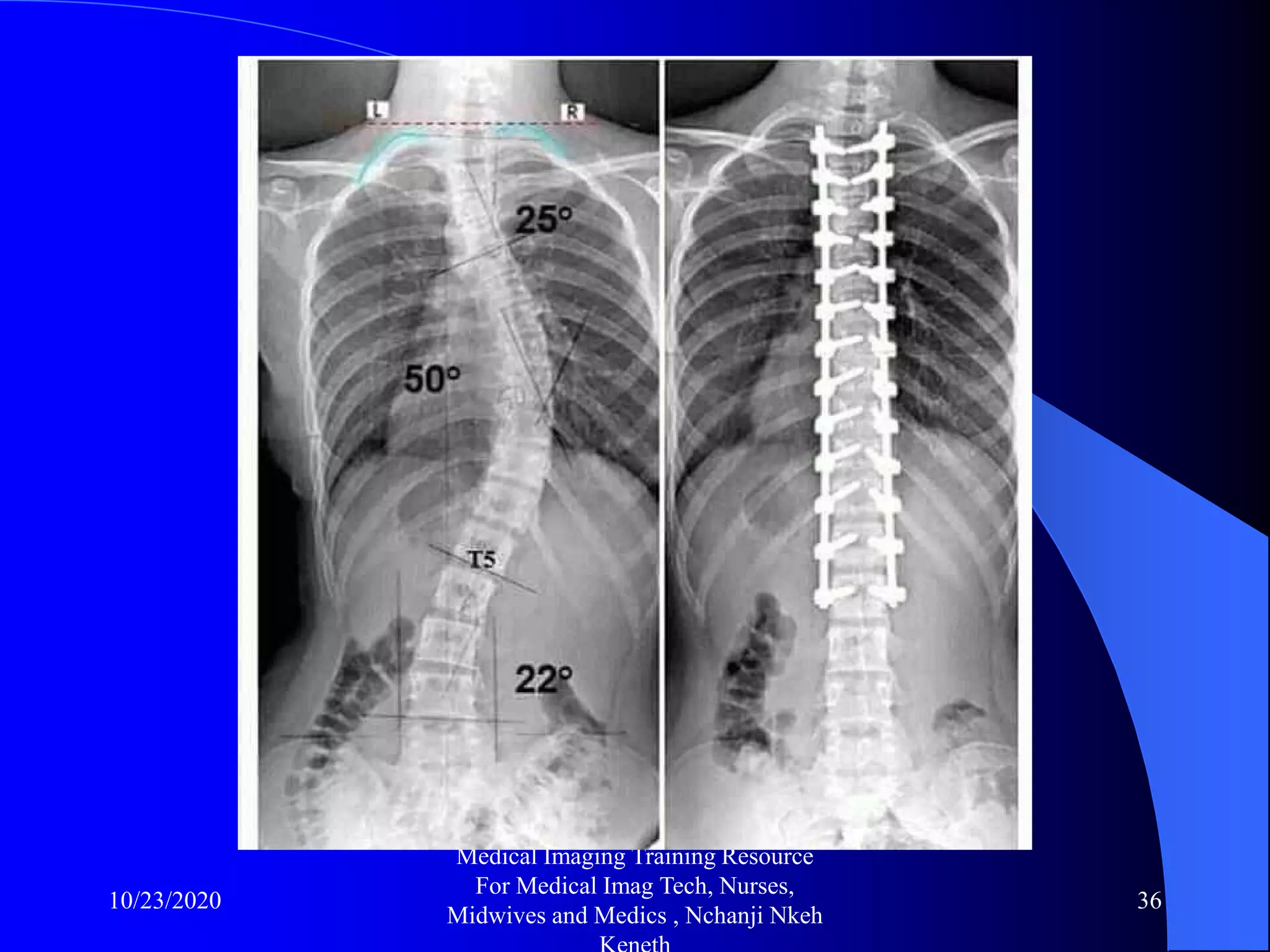 Dorso lumbar spine x-ray radiology training resource nchanji nkeh ...