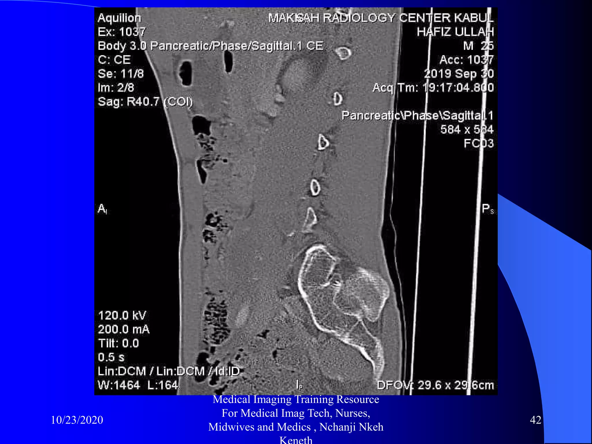 Dorso lumbar spine x-ray radiology training resource nchanji nkeh ...